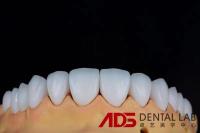 China Dental Porcelain Emax Laminate Veneers Seamlessly Customized for sale