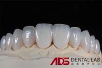 China Dental Porcelain Emax Laminate Veneers Seamlessly Customized for sale