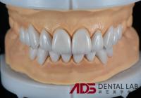 China Dental Porcelain Emax Laminate Veneers Seamlessly Customized for sale