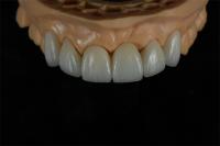 China High Stain Resistance Dental Emax Ceramic Veneers Crown For Teeth 400MPa for sale