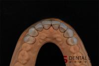 China High Stain Resistance Dental Emax Ceramic Veneers Crown For Teeth 400MPa for sale