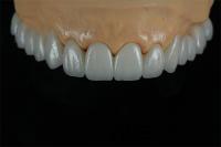 China High Stain Resistance Dental Emax Ceramic Veneers Crown For Teeth 400MPa for sale