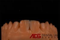 China Dentures Aesthetic Emax All Ceramic Crowns Front Teeth OEM for sale