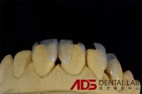 China Dentures Aesthetic Emax All Ceramic Crowns Front Teeth OEM for sale