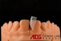 China Dentures Aesthetic Emax All Ceramic Crowns Front Teeth OEM for sale