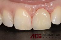 China Natural Looking Aesthetic Ceramic Emax Veneer Dental Material Customized for sale