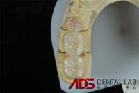 China Biocompatible Ceramic 3D Emax Veneers For Tooth Restorations for sale