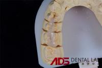China Biocompatible Ceramic 3D Emax Veneers For Tooth Restorations for sale