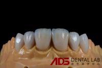 China Natural Porcelain E-Max Crown Full Veneer In Demistry Restorations for sale