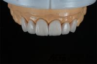 China Natural Porcelain E-Max Crown Full Veneer In Demistry Restorations for sale