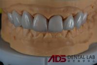 China Natural Porcelain E-Max Crown Full Veneer In Demistry Restorations for sale