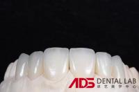 China OEM Veneers Dental E-Max Crowns Stain Resistance Minimally Invasive for sale