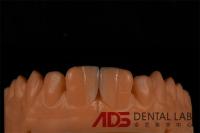 China Aesthetic Durable and Stain-Resistant Dental Veneers from direct China Shenzhen dental lab for sale