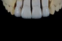 China Veneers Stain Resistant Comfortable Fit for sale