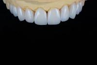 China Custom Emax Dental Veneer from Leading China Dental Lab for sale