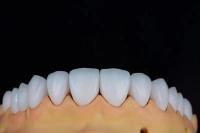 China Custom Emax Dental Veneer from Leading China Dental Lab for sale