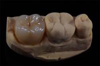 China Layered Zirconia Crown for Natural Aesthetics from China Dental Lab for sale