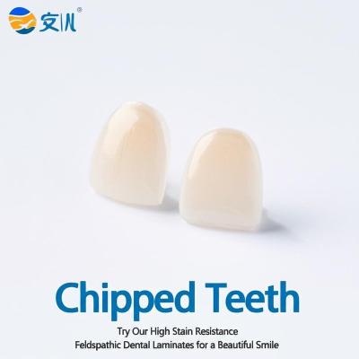 China Affordable 0.3-0.5mm Thickness Feldspathic Dental Veneers with 16 Shades Color Options for sale