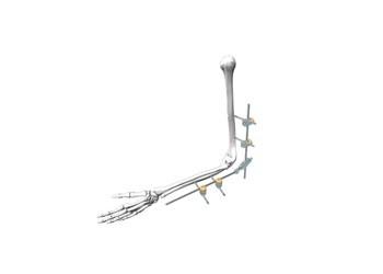 China Safety External Fixation System Dissection IV Φ5- Children’S Elbow Fixation for sale