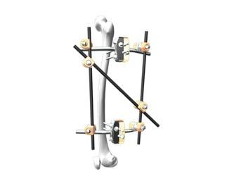 China Femur Spanning Orthopedic External Fixator Apply To Fracture Treatment for sale