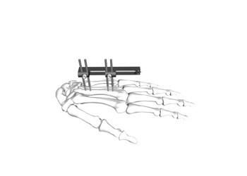 China Metacarapale External Fixation System Sliver / Black Color Long Lifespan for sale