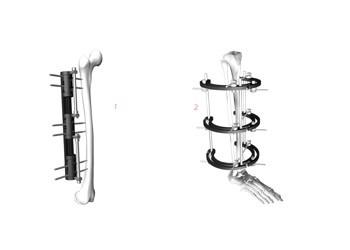 China Llizarov Tibia Ring External Fixator Lengthening For Delayed Fracture Healing for sale