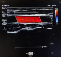 China ATL EPIQ5 new original convex array ultrasound probe L12-5 for sale