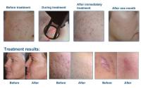 China Portable 60W Fractional CO2 Laser Machine for Freckles Removal and Skin Resurfacing for sale