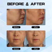China New XERF Dual Frequency RF Skin Tightening Machine 6.78MHz & 2MHz Monopolar RF Anti-Aging Device XERF Machine for sale