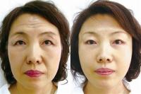 China 10MHZ Radio Frequencies Acne Removal Machine With Non Invasive for sale