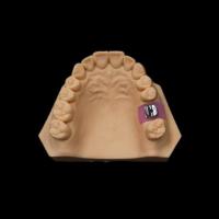 China Dental Implant Screw PFM Richmond Crown 15 Year Durability Osseointegration for sale