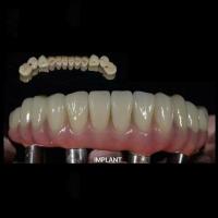 China Dental Implant Screw PFM Richmond Crown 15 Year Durability Osseointegration for sale