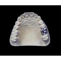 China FCC Richmond Crown Full Cast Crown with Post for Endodontically Treated Teeth Dental Restoration for sale