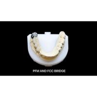 China Full Cast Crown FCC Restorative Dentistry Metal Alloy Minimal Tooth Reduction 10-15 Year Longevity for sale