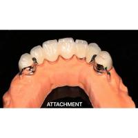 China Precision Dental Attachment for Prosthodontics Tooth Preservation High Grade Alloy for sale