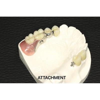China Dental Precision Connector for Partial Dentures Improved Stability Aesthetic Design 2 Piece for sale
