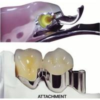 China Dental Precision Connector for Partial Dentures Improved Stability Aesthetic Design 2 Piece for sale