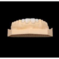 China Porcelain Tooth Veneer 0.3mm Minimally Invasive Stain Resistant for Cosmetic Dentistry for sale