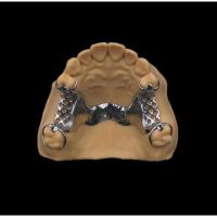 China Biocompatible Dental Metal Framework Precision Fit Durability Framework Dental for sale