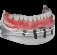 China CCP Transvisse Design Dental Implant Metal Tray Rigid Stainless Steel Impression Tray for sale