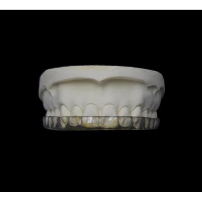 China Custom Dental Occlusal Splint for TMJ Disorder Relief Bruxism Protection Acrylic for sale
