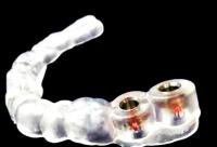 China Medical Grade Resin Implant Surgical Guide Custom Fit for Dental Surgery Precision 3shape for sale