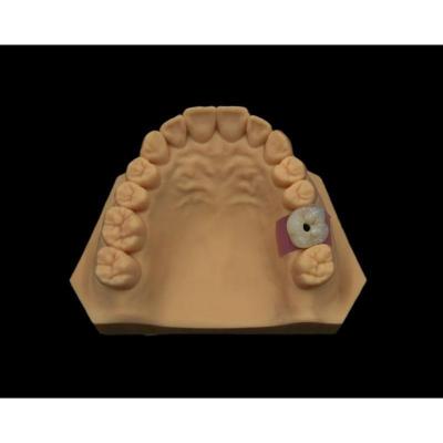 China Chrome Cobalt PFM Implant Screw Reusable Abutment 4.0mm Diameter Dental for sale