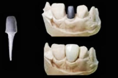 China Chrome Cobalt PFM Richmond Crown Dental Restoration for Limited Space 1.5mm for sale