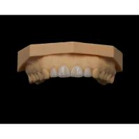 China High Translucency Dental Emax Crown 0.5mm Thickness for Esthetic Restorations for sale