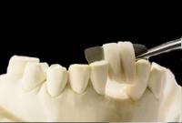 China Dental Maryland Bridge No Prep Resin Bonded Fixed Partial Denture 0.3mm for sale
