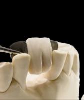China Dental Maryland Bridge No Prep Resin Bonded Fixed Partial Denture 0.3mm for sale