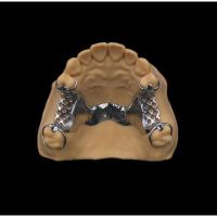 China Chrome Cobalt Dental Palate Prosthetics High Biocompatibility Corrosion Resistance 1.5mm Thickness for sale
