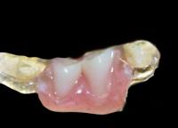 China Transparent Dental Clasp Invisible Denture Clasp Clear Hold 0.5mm Professional Grade for sale