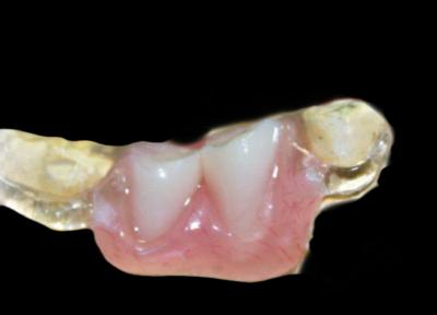 China Transparent Dental Clasp Invisible Denture Clasp Clear Hold 0.5mm Professional Grade for sale
